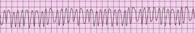 ACLS Precourse Self Assessment Answers » ACLS Pre Test Answers